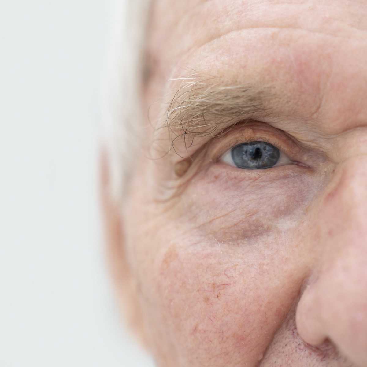 6 Effective Tips for Cataract Prevention